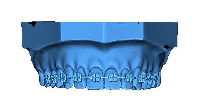Human Teeth with Braces 3D model 3D printable | CGTrader