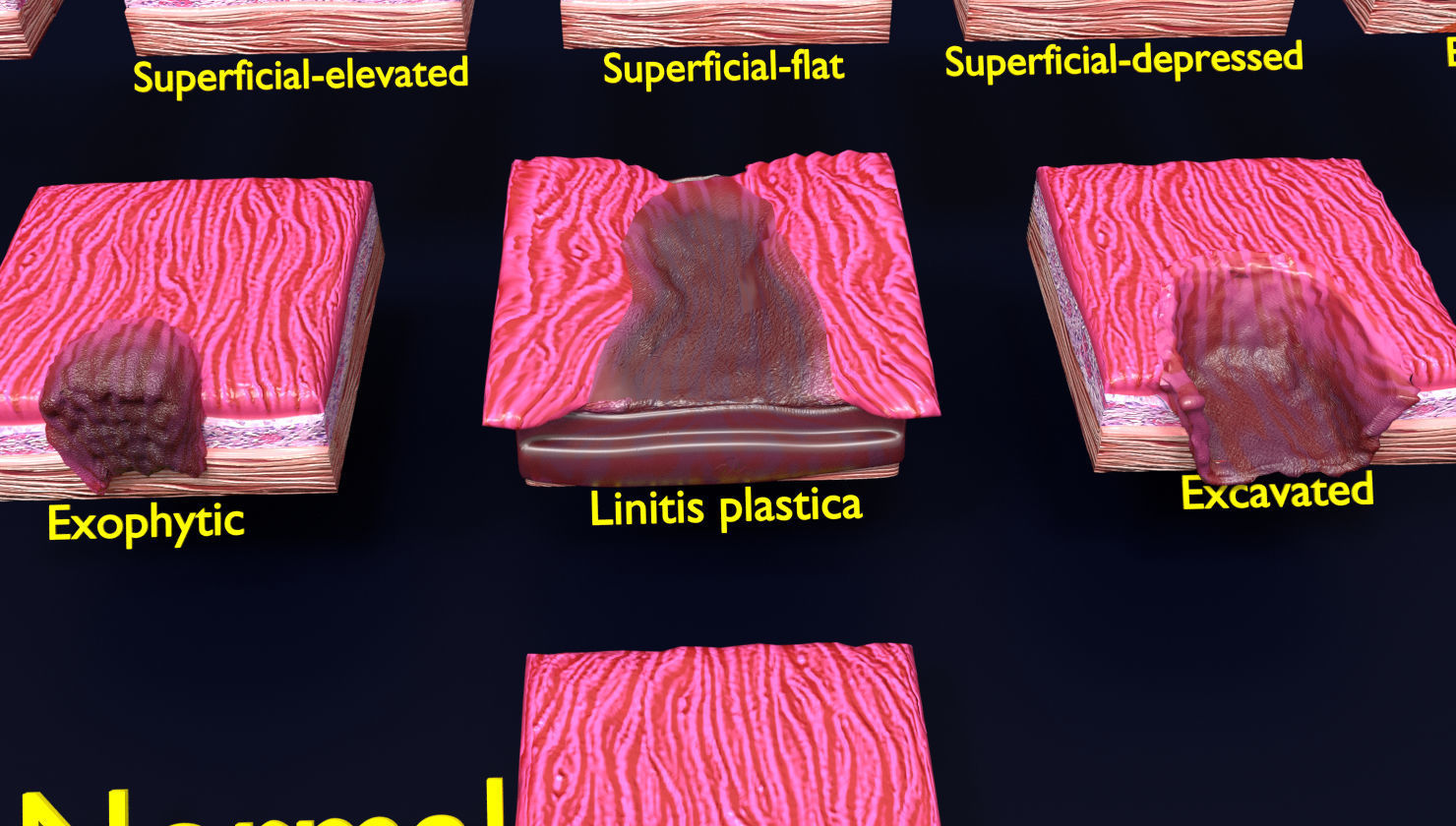 Gastric stomach cancer stages labelled 3D model | CGTrader