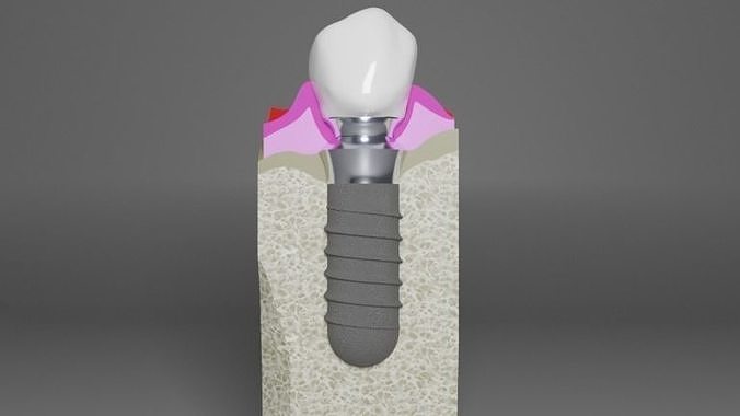 Peri-implant region - Anatomy 3D model | CGTrader