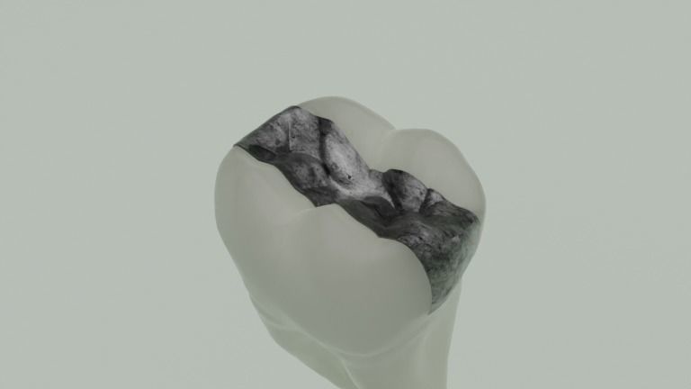 Dental restorations - Blacks Class I to V 3D model | CGTrader