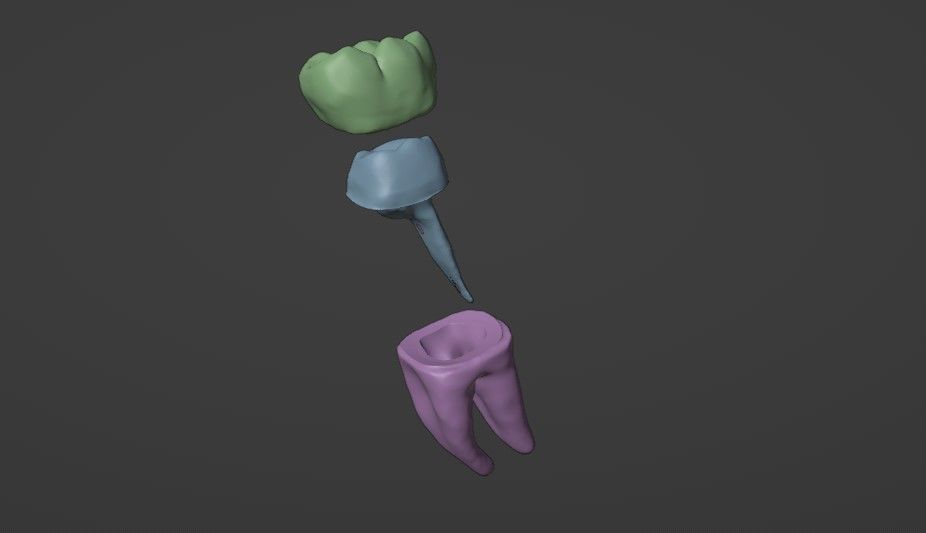 Fiber post and core with single crown - Posterior tooth 3D model | CGTrader
