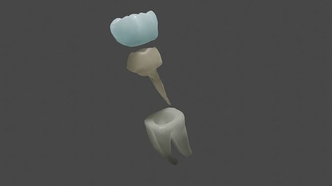 Fiber post and core with single crown - Posterior tooth 3D model | CGTrader