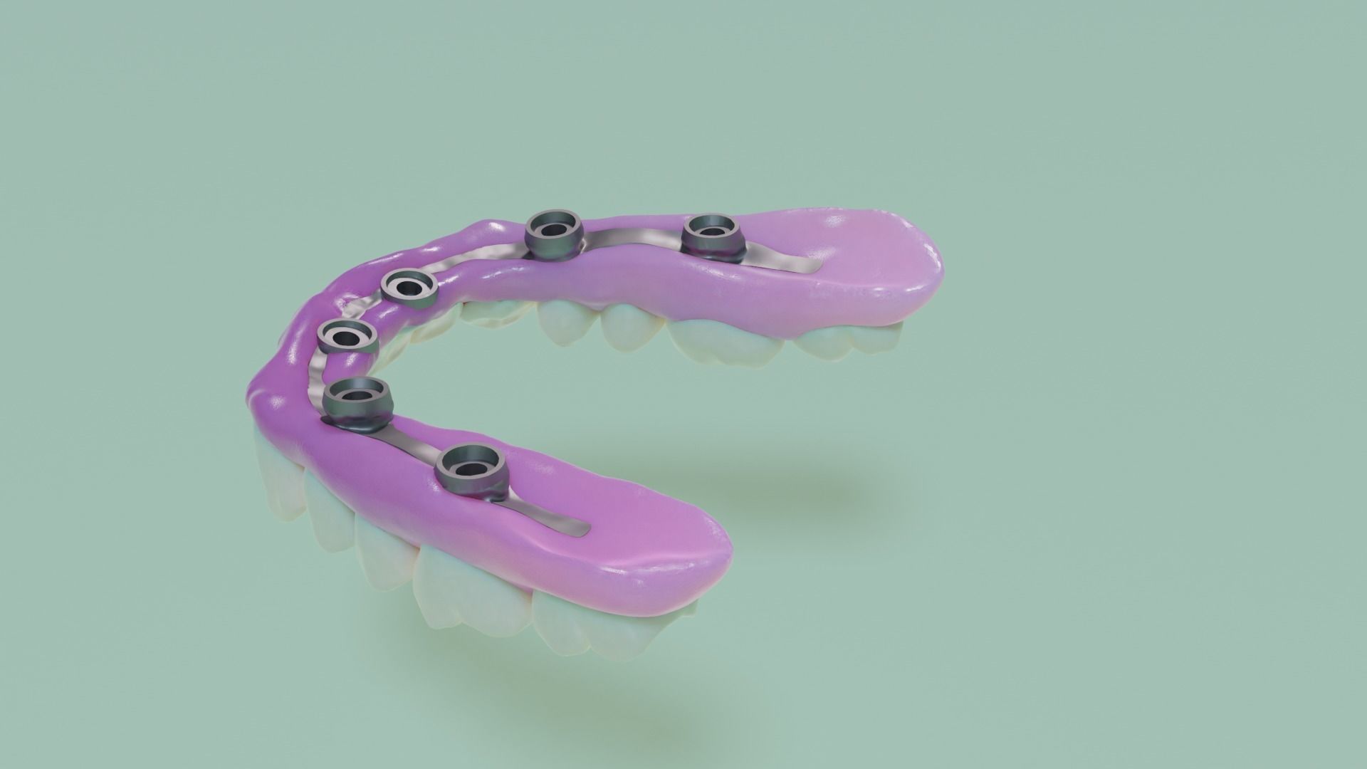 Full arch fixed implant-supported prostheses - Dental implant 3D model ...