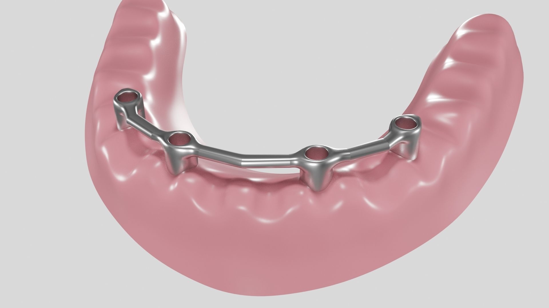 Hibrid implant bar attachment 3D model | CGTrader