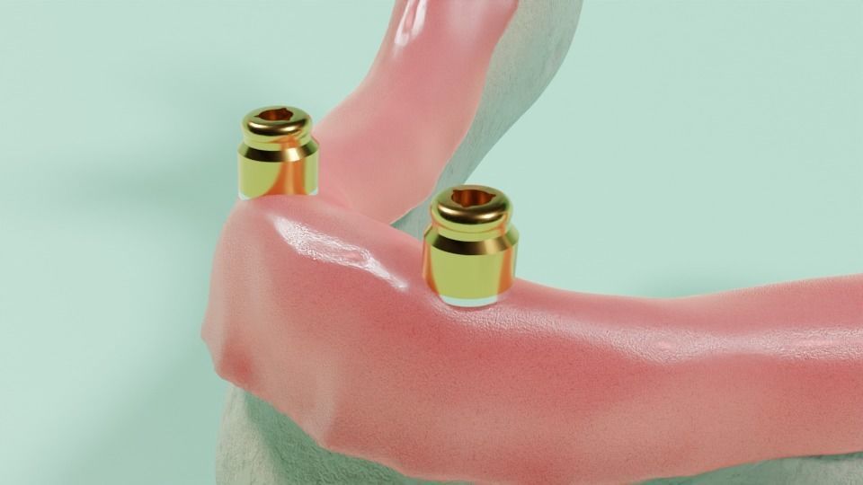 Overdenture lower denture retained by Oring-like abutments 3D model ...