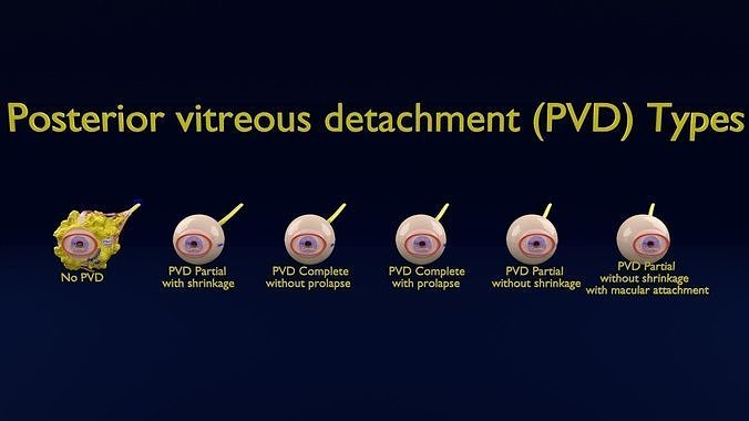 Posterior Vitreous Detachment Oct