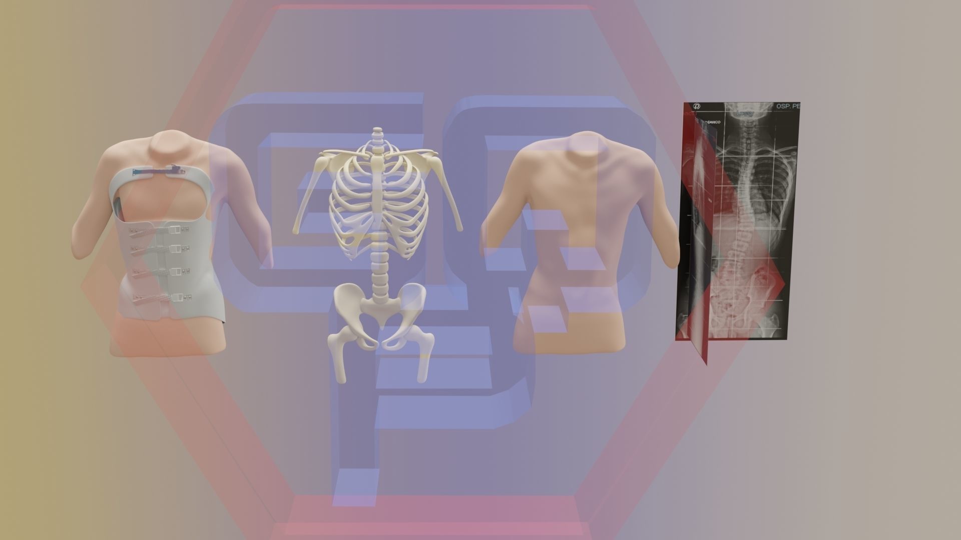 3D model Orthopedic brace corset scoliosis animation VR / AR / low-poly ...