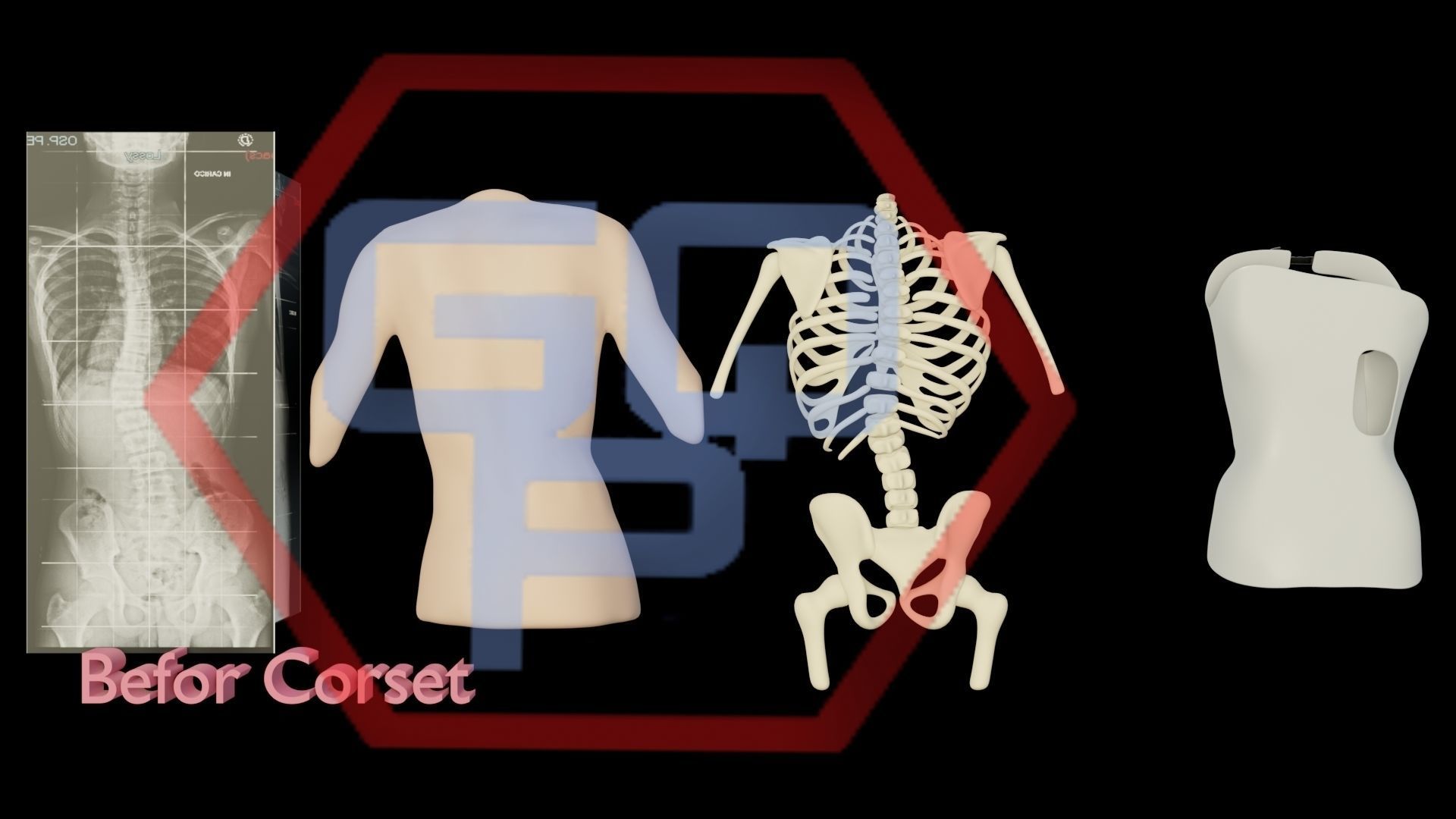 3D model Orthopedic brace corset scoliosis animation VR / AR / low-poly ...