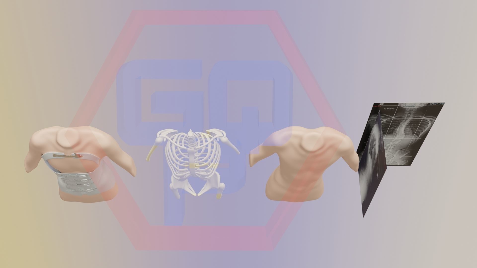 3D model Orthopedic brace corset scoliosis animation VR / AR / low-poly ...