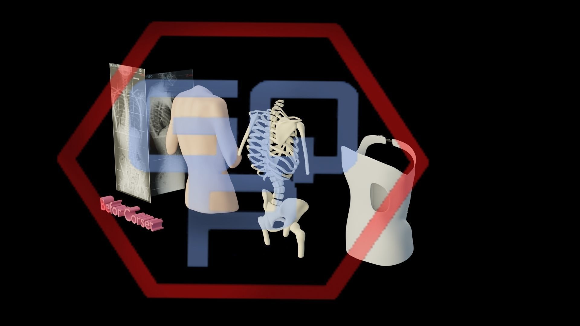 3D model Orthopedic brace corset scoliosis animation VR / AR / low-poly ...