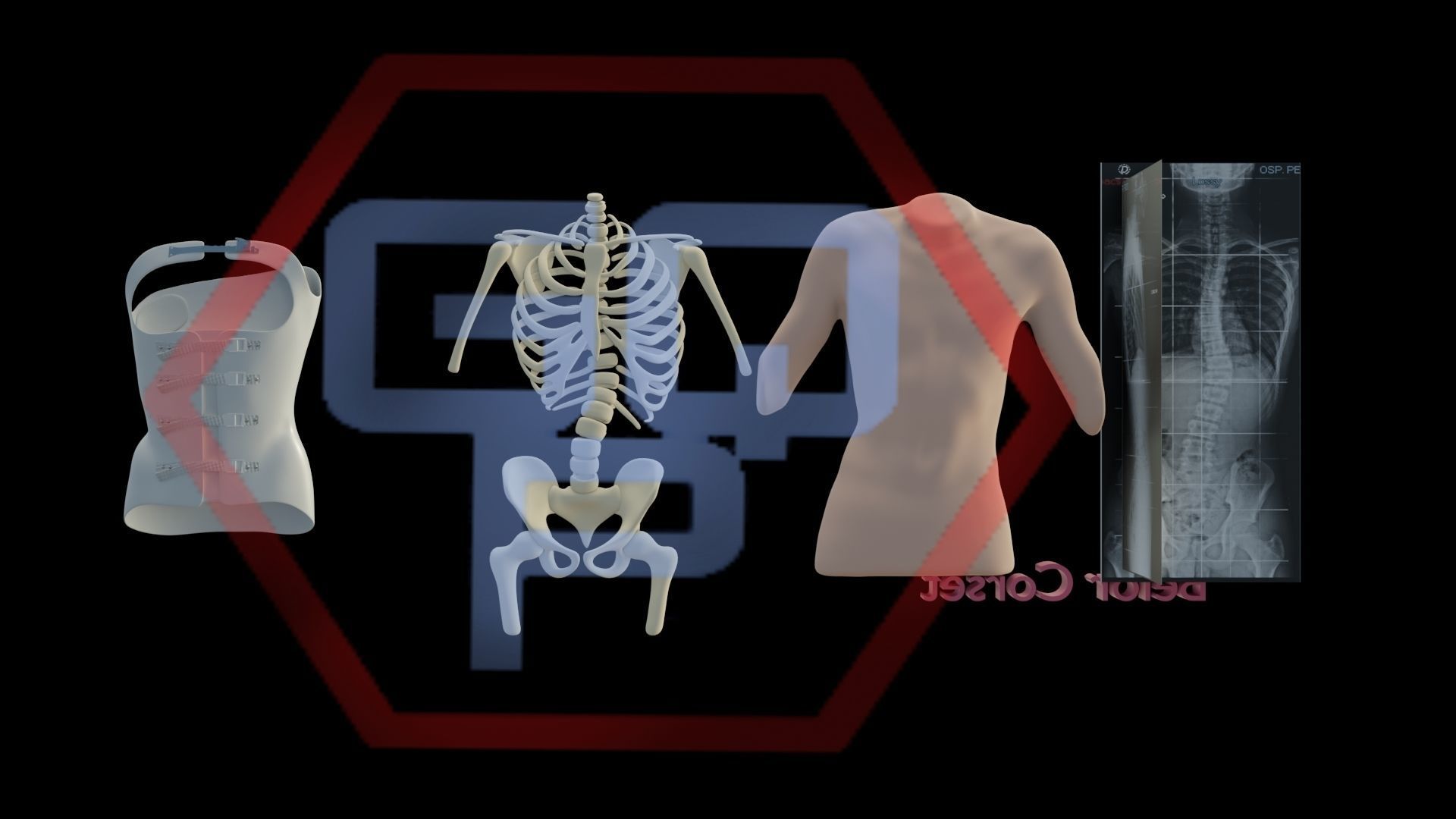 3D model Orthopedic brace corset scoliosis animation VR / AR / low-poly ...