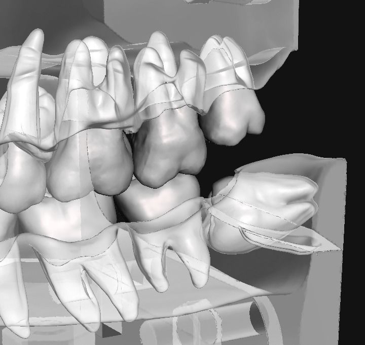 D011 Oral surgery and perio model 3D model 3D printable | CGTrader