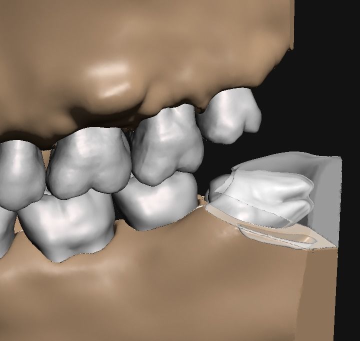 D011 Oral surgery and perio model 3D model 3D printable | CGTrader