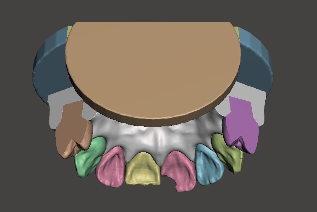 3D Dental Custom Model Anterior Class IV and Class VI Segmented 3D ...