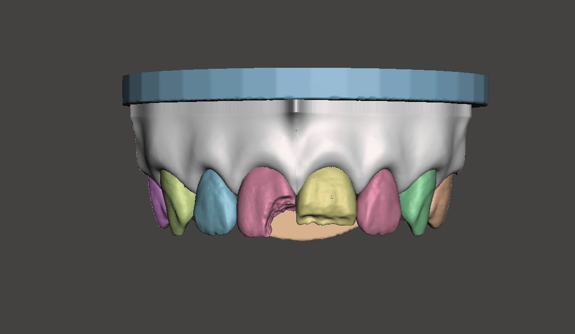 3D Dental Custom Model Anterior Class IV and Class VI Segmented 3D ...