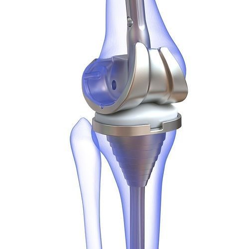 Knee Replacement Implant 3D model | CGTrader