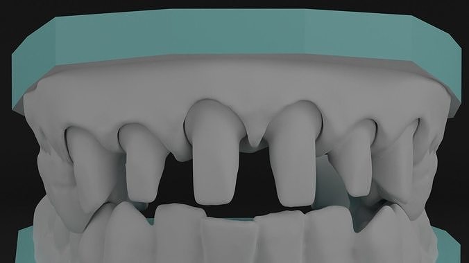 Human teeth restoration 3D model 3D printable | CGTrader