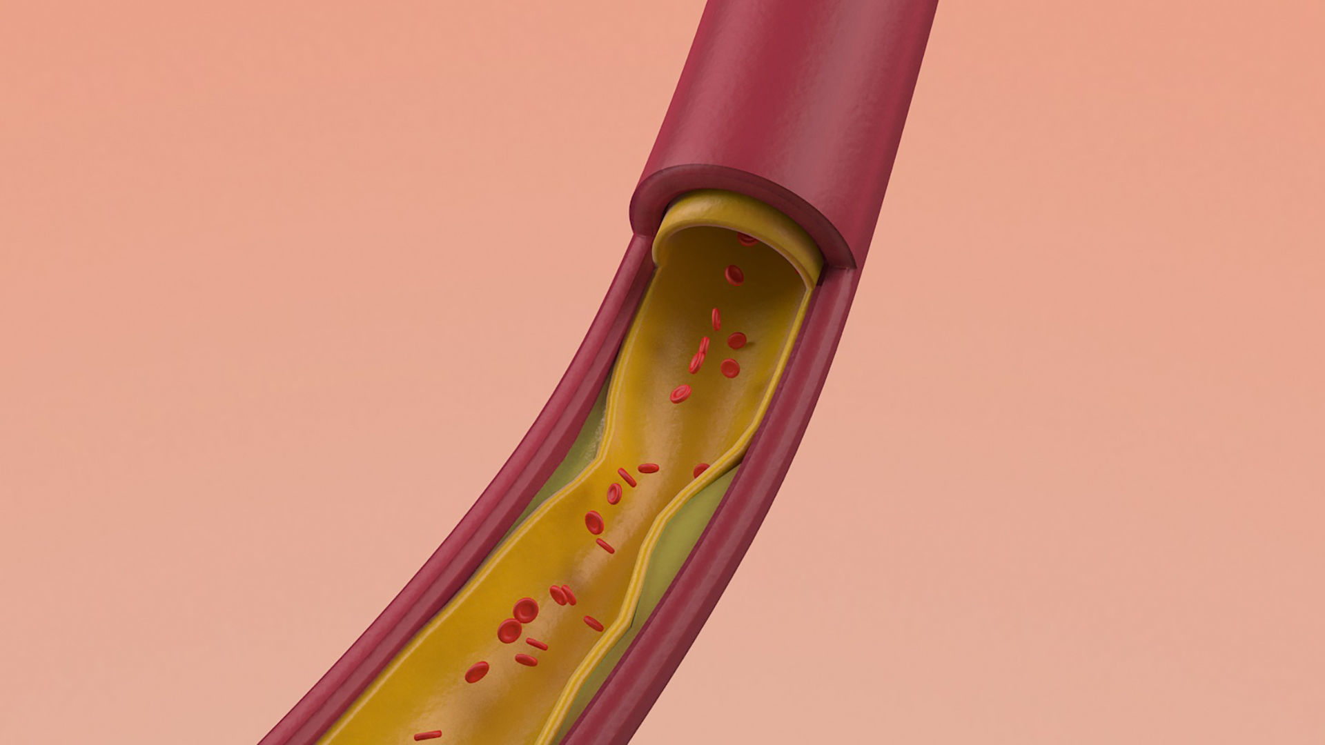 Artery Vein Clog Clot Clogged Stream Bloodflow Layers Section 3D model ...