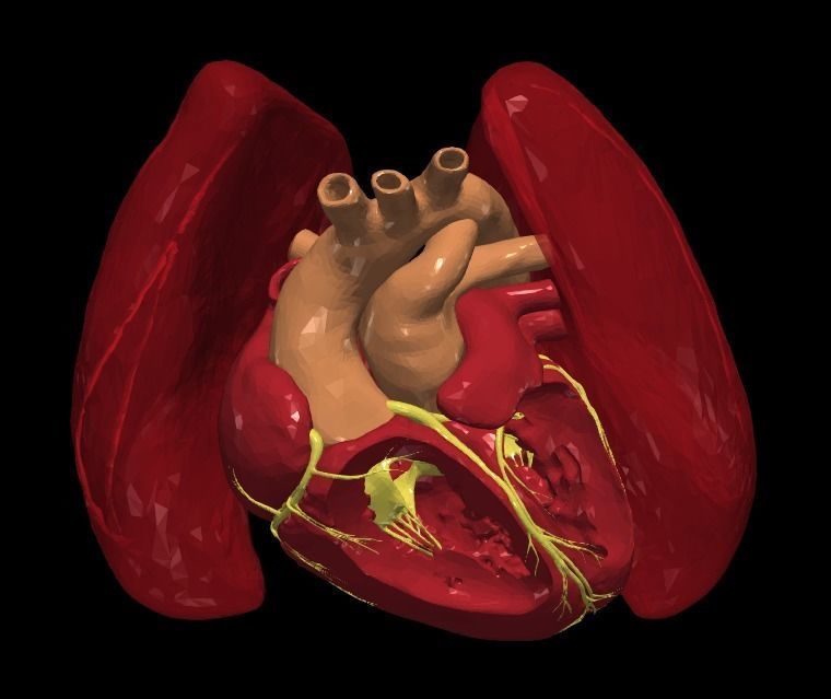 3D model of heart with transposition of the great arteries 3D model ...