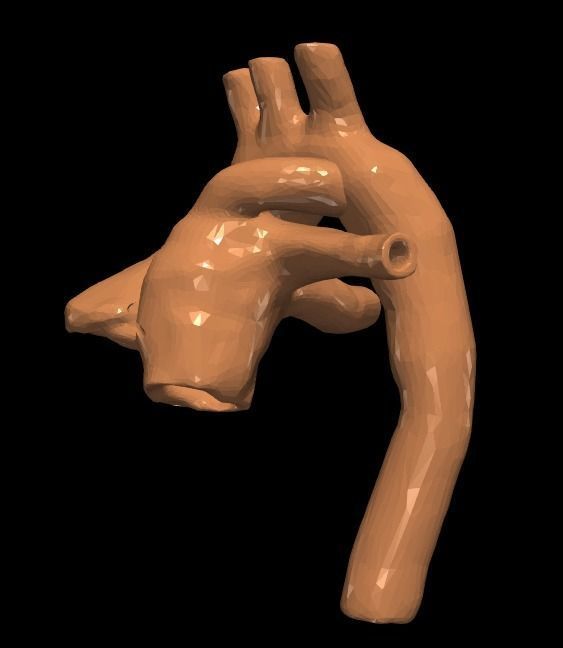 3D model of heart with transposition of the great arteries 3D model ...