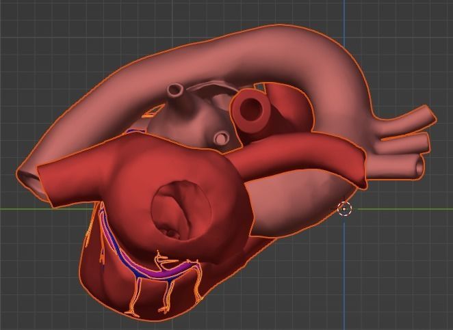 3d model of heart with atrial septal defect 3D model | CGTrader