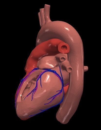 3d model of heart with atrial septal defect 3D model | CGTrader