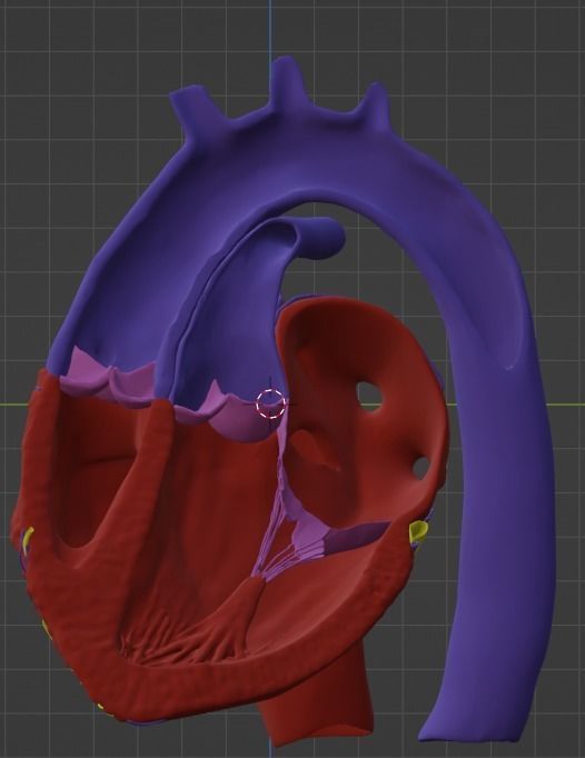 3d model of heart with transposition of the great arteries 3D model 3D ...