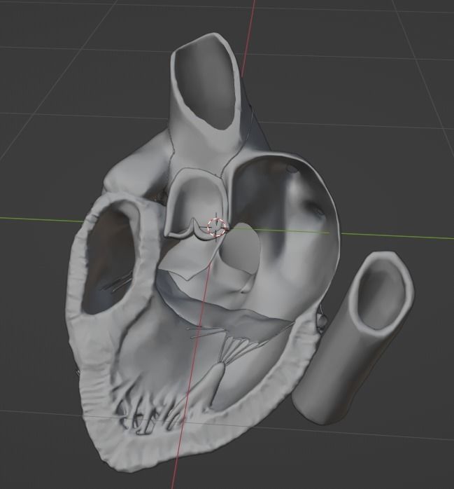 3d model of heart with atrioventricular septal defect 4 chamber 3D ...