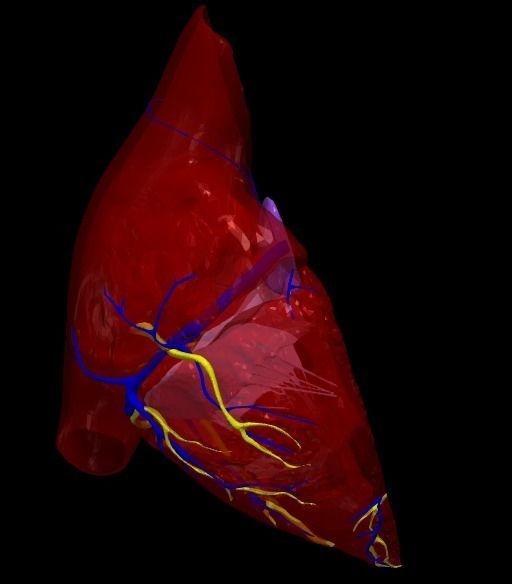 3d model of heart with atrioventricular septal defect 4 chamber 3D ...