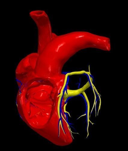 3d model of heart with atrial septal defect 3D model 3D printable ...
