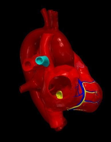 3d model of heart with PAPVC 3D model 3D printable | CGTrader