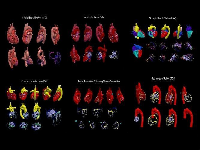 Congenital Heart Disease - 7pack 3D model | CGTrader