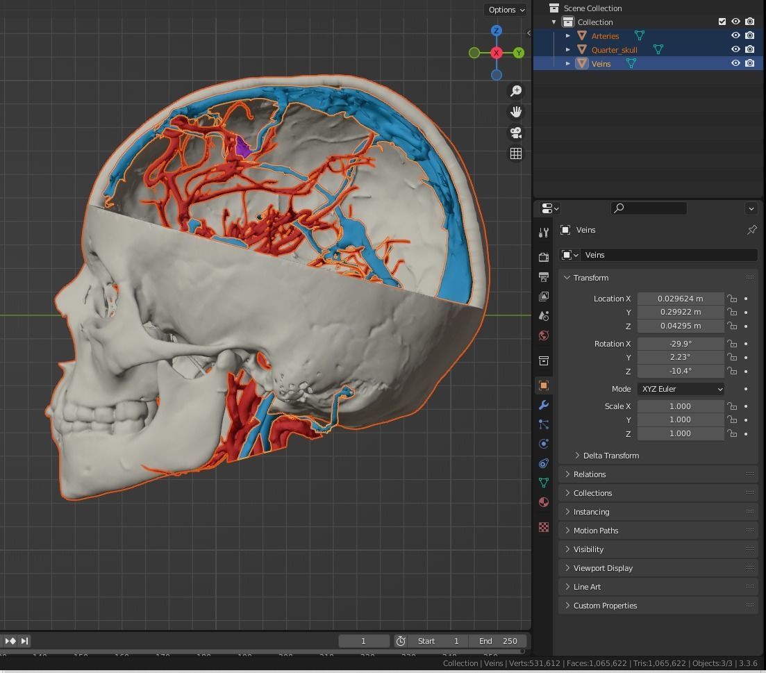 3D Model of Brain Arteriovenous Malformation 3D model 3D printable ...