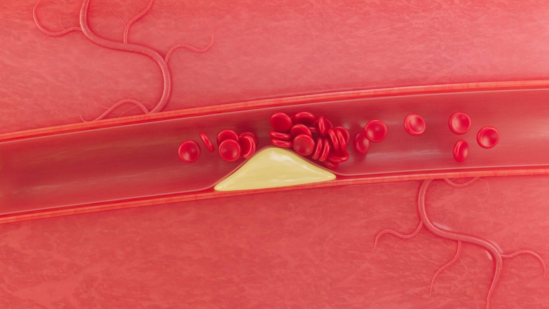 Blood Vascular blockage 3D model animated | CGTrader