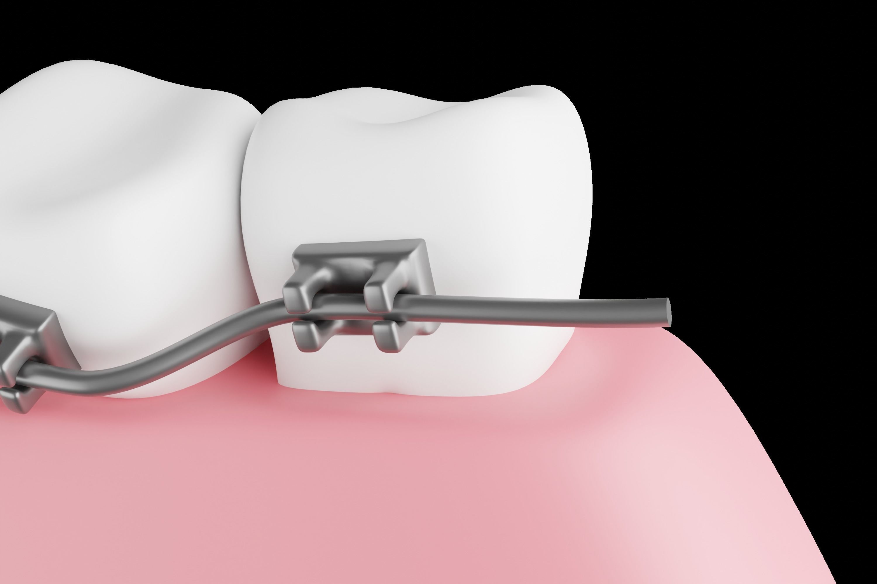 Dental braces system for bite correction 3D model | CGTrader
