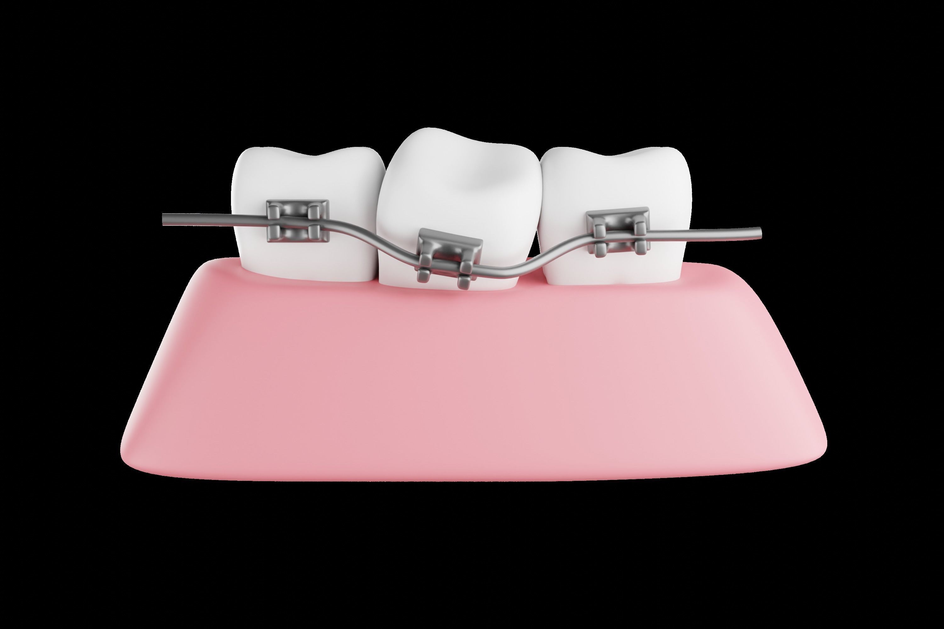 Dental braces system for bite correction 3D model | CGTrader