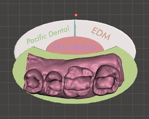 Posterior class 1 MOD Cups Reduction Class II by EDM DENTAL 3D model 3D ...