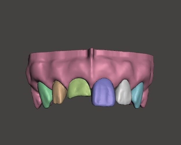 Segmented Anterior Crown Preparation and direct veneer by EDM 3D model ...