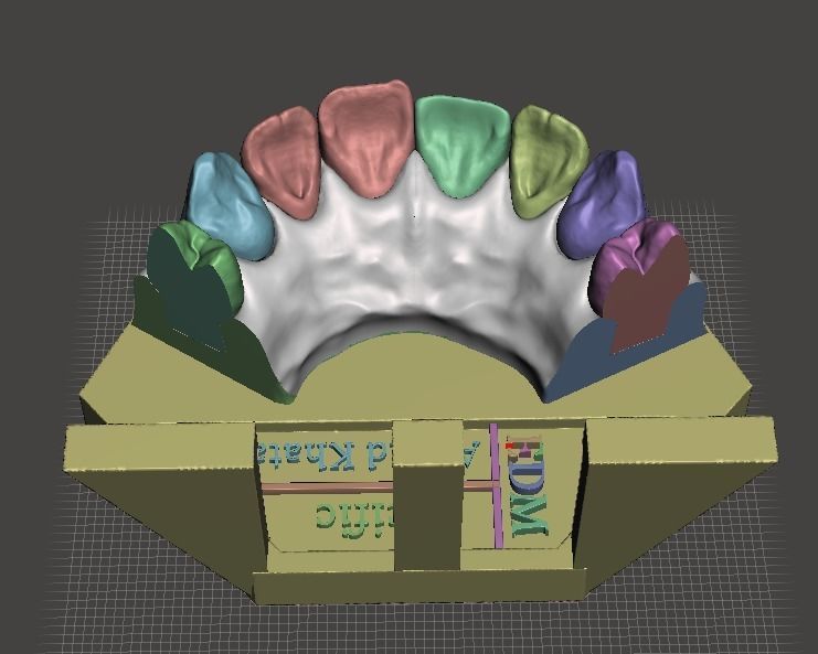 Segmented Anterior Direct Veneer by EDM DENTAL PRACTICE 3D model 3D ...