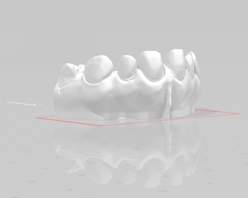 Segmented Anterior Veneer Preparation by EDM DENTAL PRACTICE 3D model ...