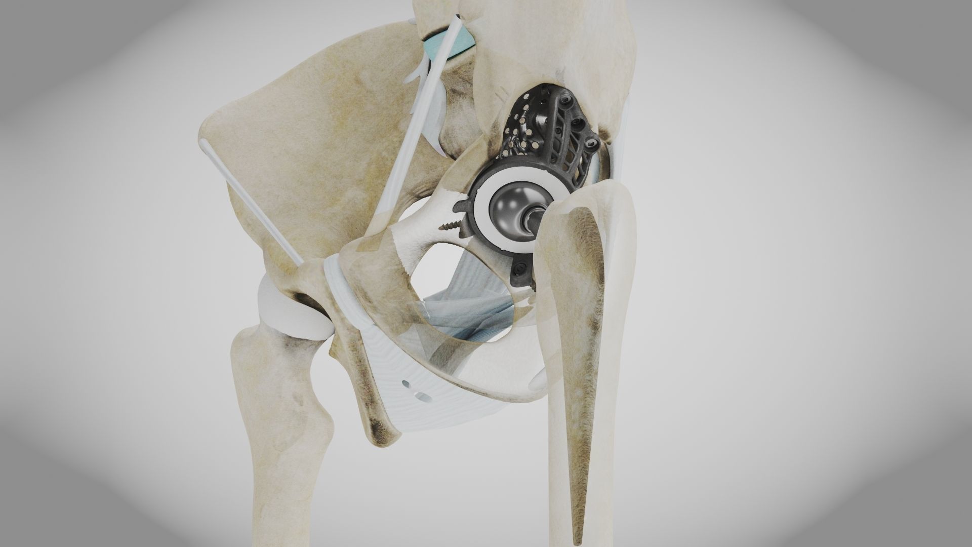 3D model Replaced Pelvic Implant VR / AR / low-poly | CGTrader