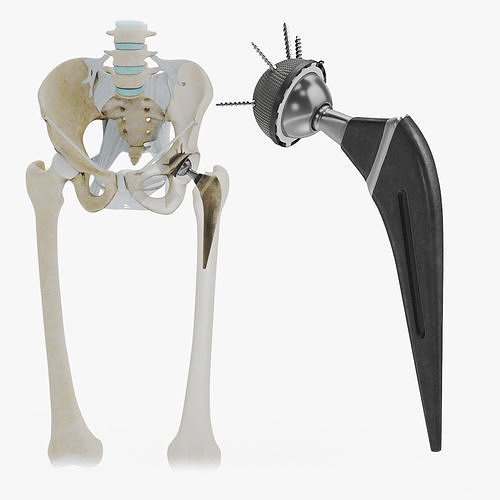 3D model Replaced Hip Implant VR / AR / low-poly | CGTrader