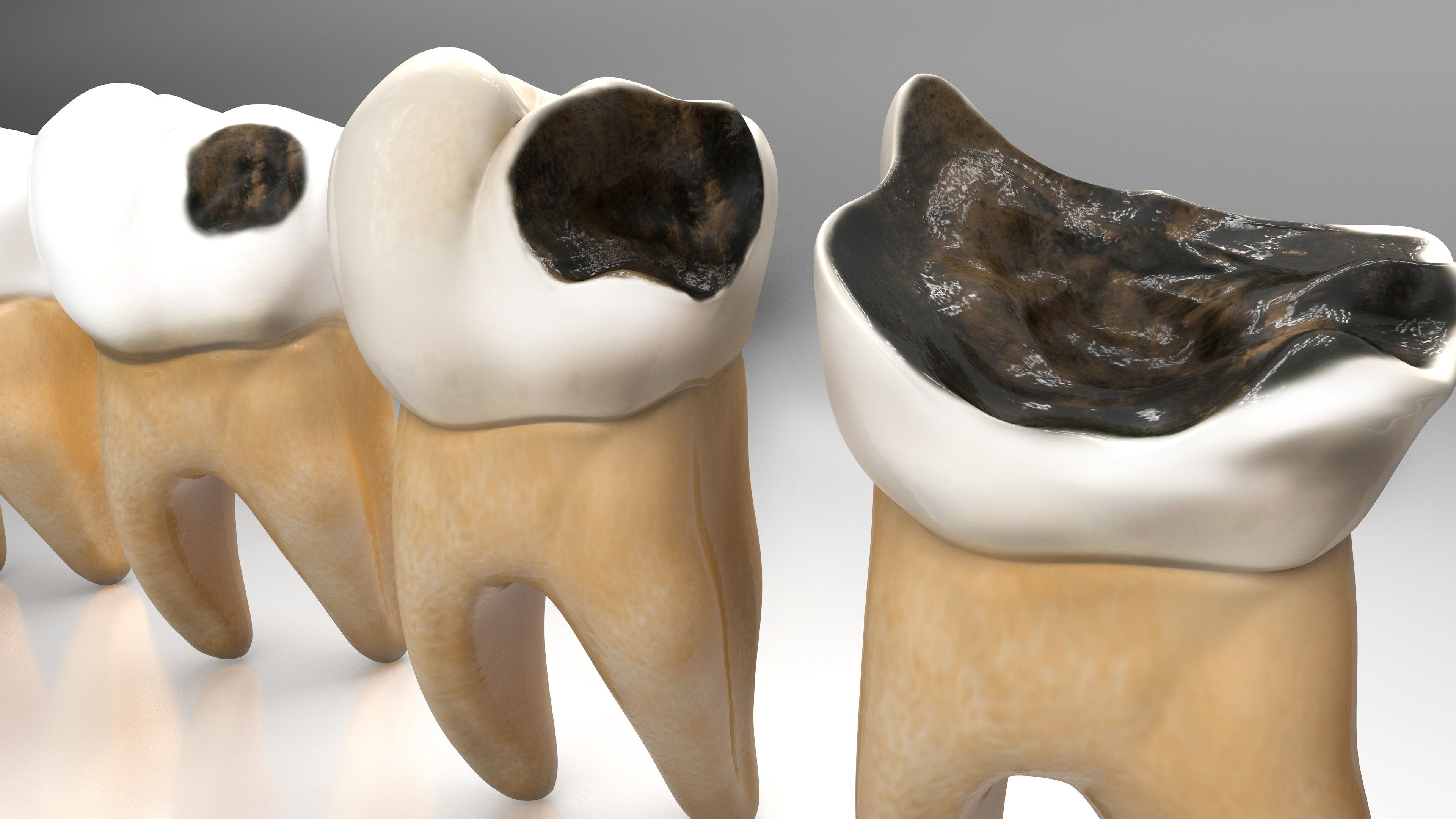 3D model Human Tooth Decay A 3D Dental Caries Progression Model VR / AR ...
