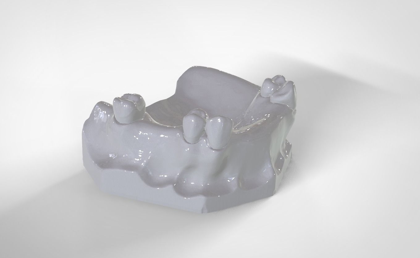Digital Removable Partial Denture Framework 3D model 3D printable ...