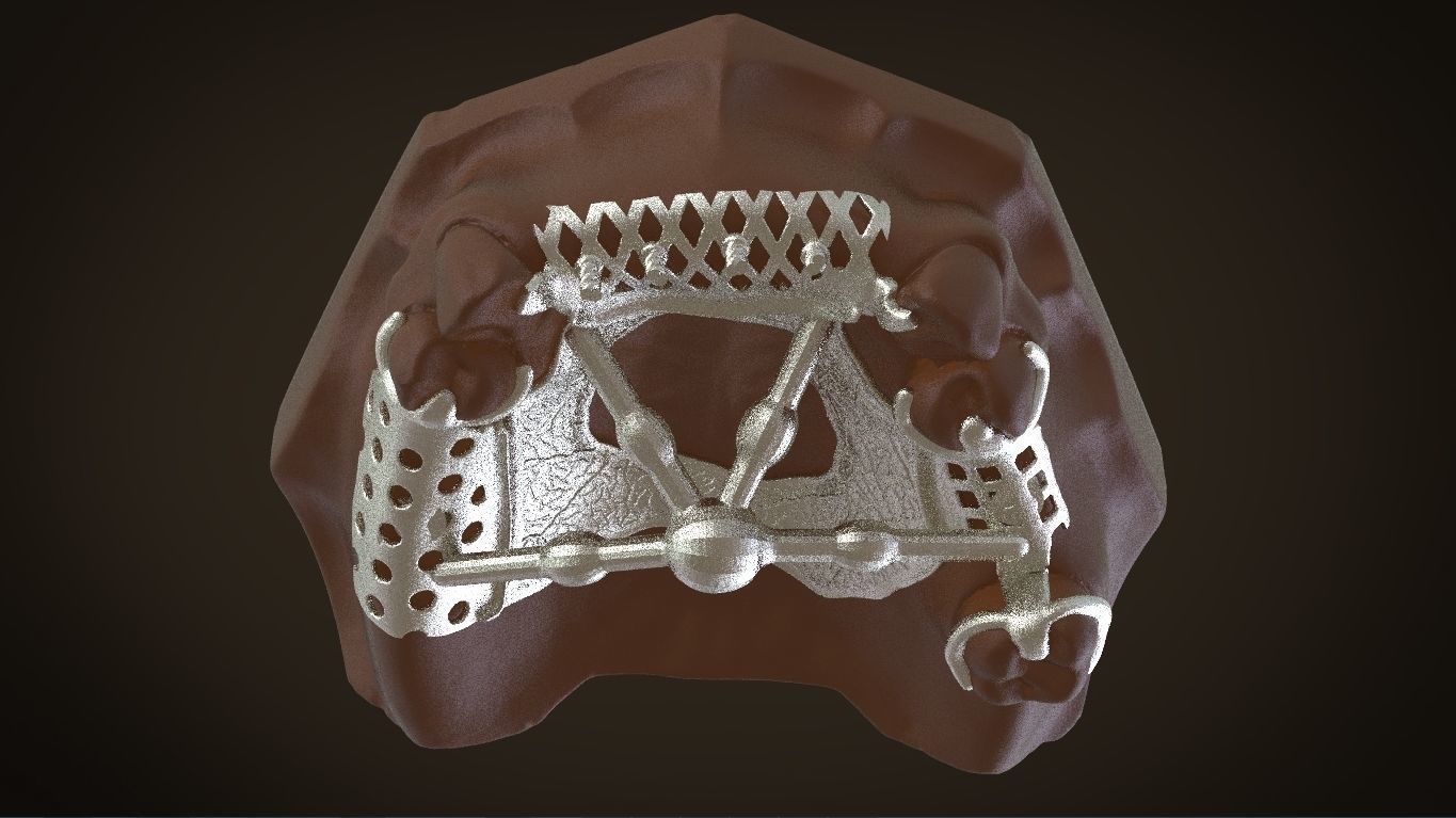 Digital Removable Partial Denture Framework 3D model 3D printable ...